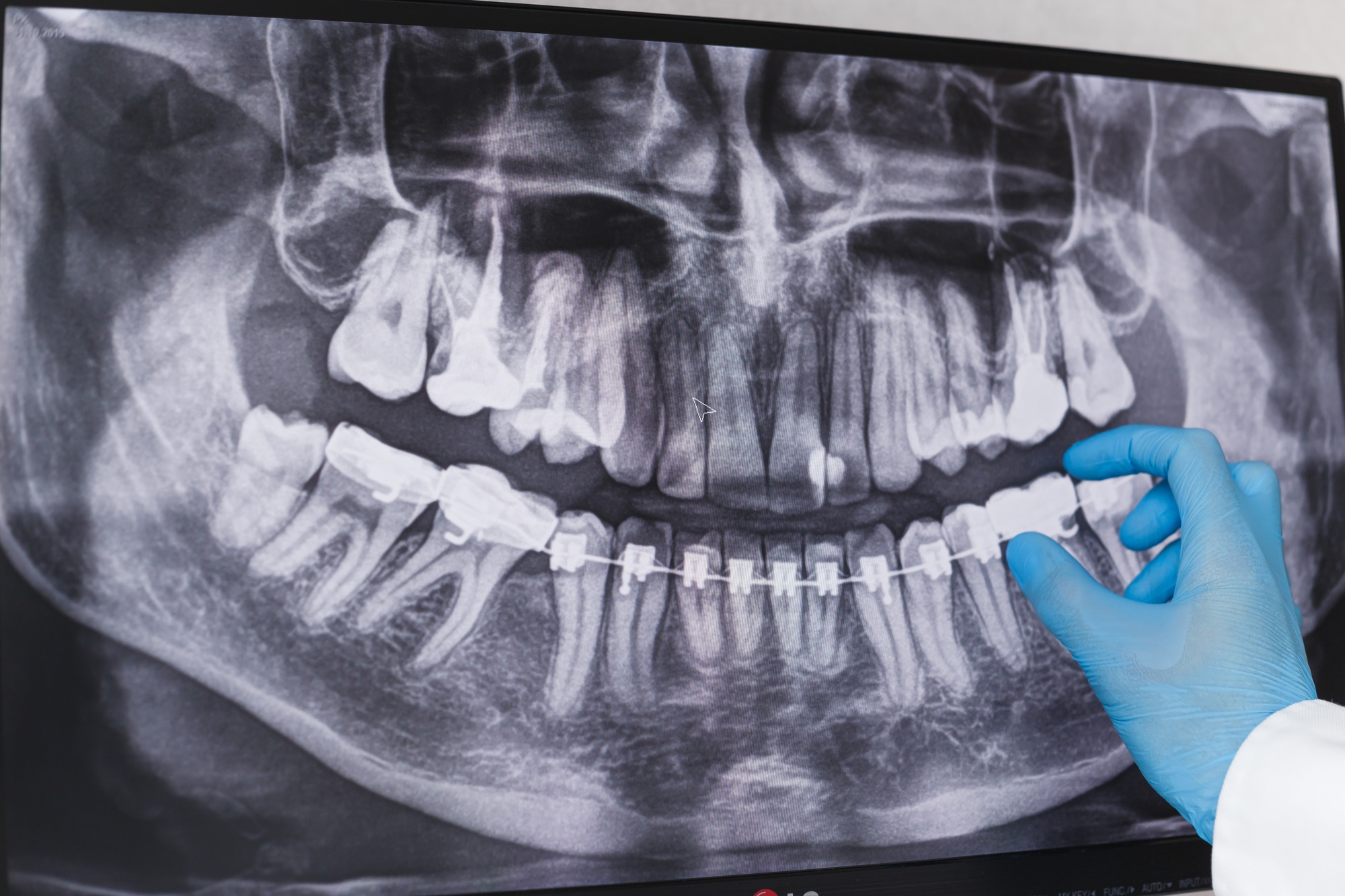 X-rays (Digital Radiography) | Kita Dental